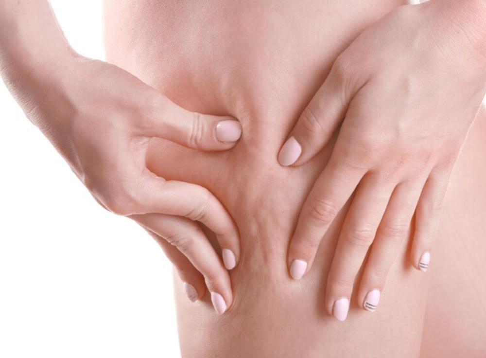 Cellulite: Where does it come from and how to get rid of it effectively ...